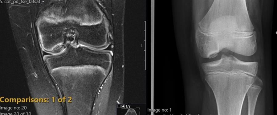 Knee OCD - Paediatric Orthopaedic Surgeon in Hampshire