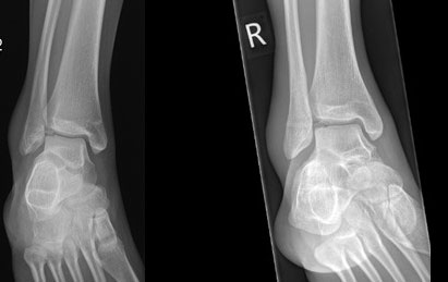 Ankle OCD - Paediatric Orthopaedic Surgeon in Hampshire | Mr Darius ...